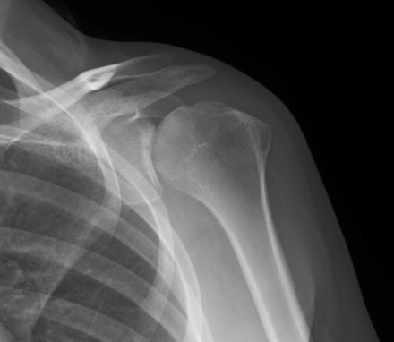 Psych Distress Magnifies Patient Perception of Shoulder Pain - OrthoBuzz