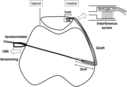 Improved Patellar Stiffness Proves Benefits of Tensioned MPFL ...