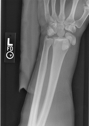 JBJS Case Connections—Wrong-Way Wrist Bones - OrthoBuzz