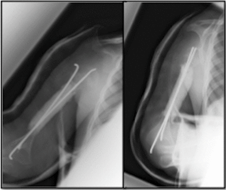 JBJS Case Connections—Induced Membrane Technique Fills Many Bone Voids ...