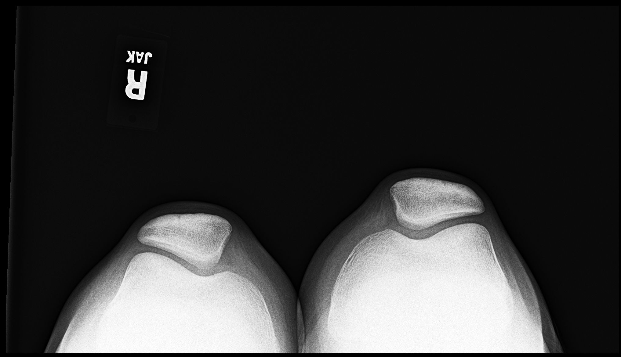 jbjs-jopa-image-quiz-a-15-year-old-girl-with-dislocated-patella