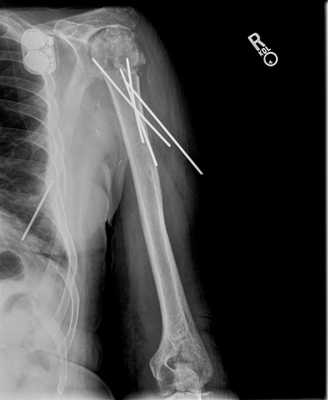 Case Connector “Watch”—Beware Wayward Wires in the Shoulder Girdle ...