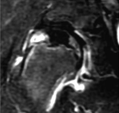 Reperfusion Patterns in Legg-Calve-Perthes Disease - OrthoBuzz