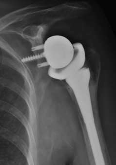 What’s New in Shoulder and Elbow Surgery - OrthoBuzz