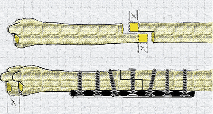 Step-Cut Osteotomy for Ulnar Shortening - OrthoBuzz
