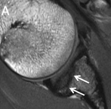 JBJS Case Connections—Osteochondritis Dissecans: Baseball and Genetics ...
