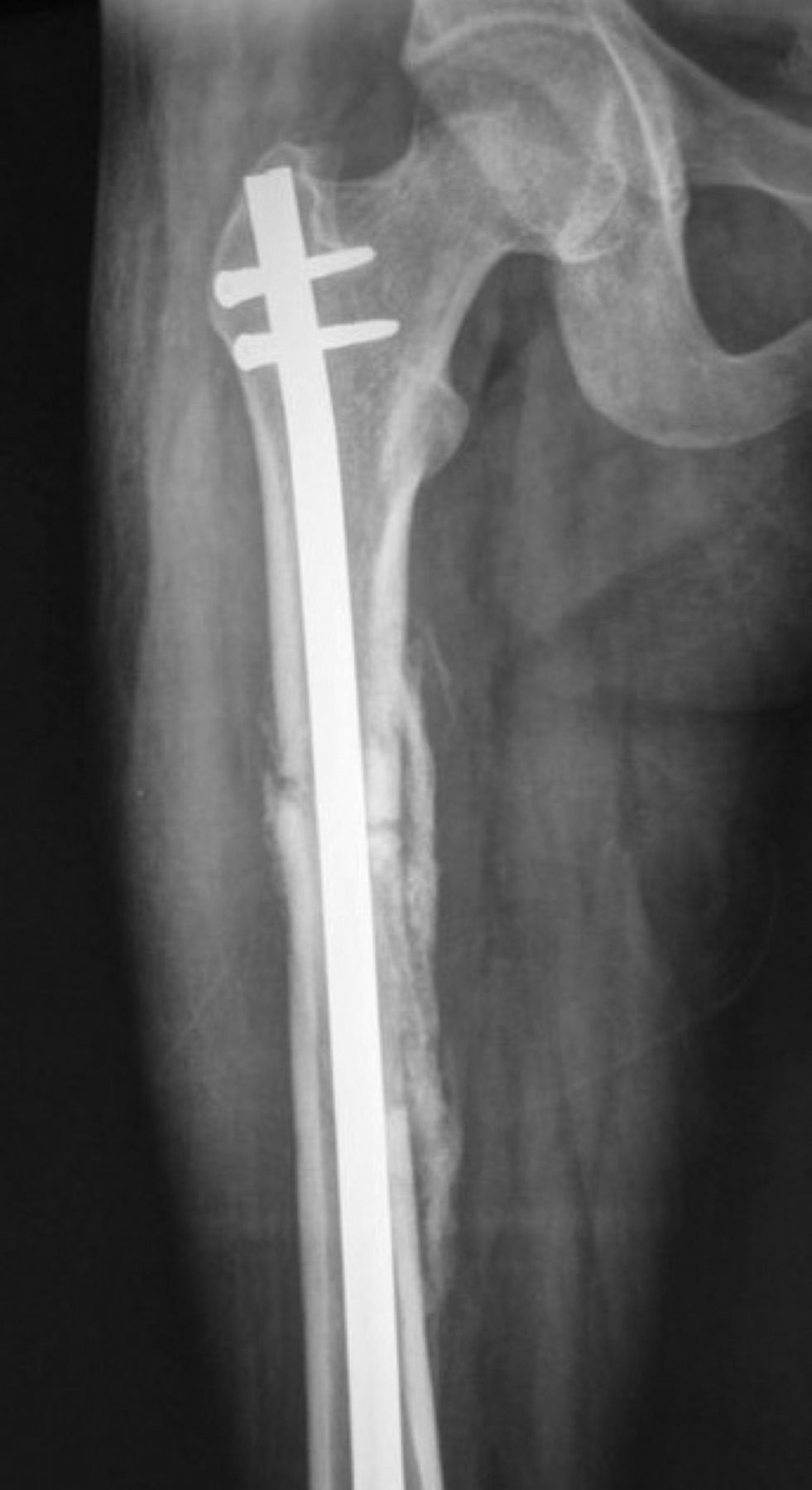 JBJS Editor’s Choice: Fracture-Care Progress in the Developing World ...