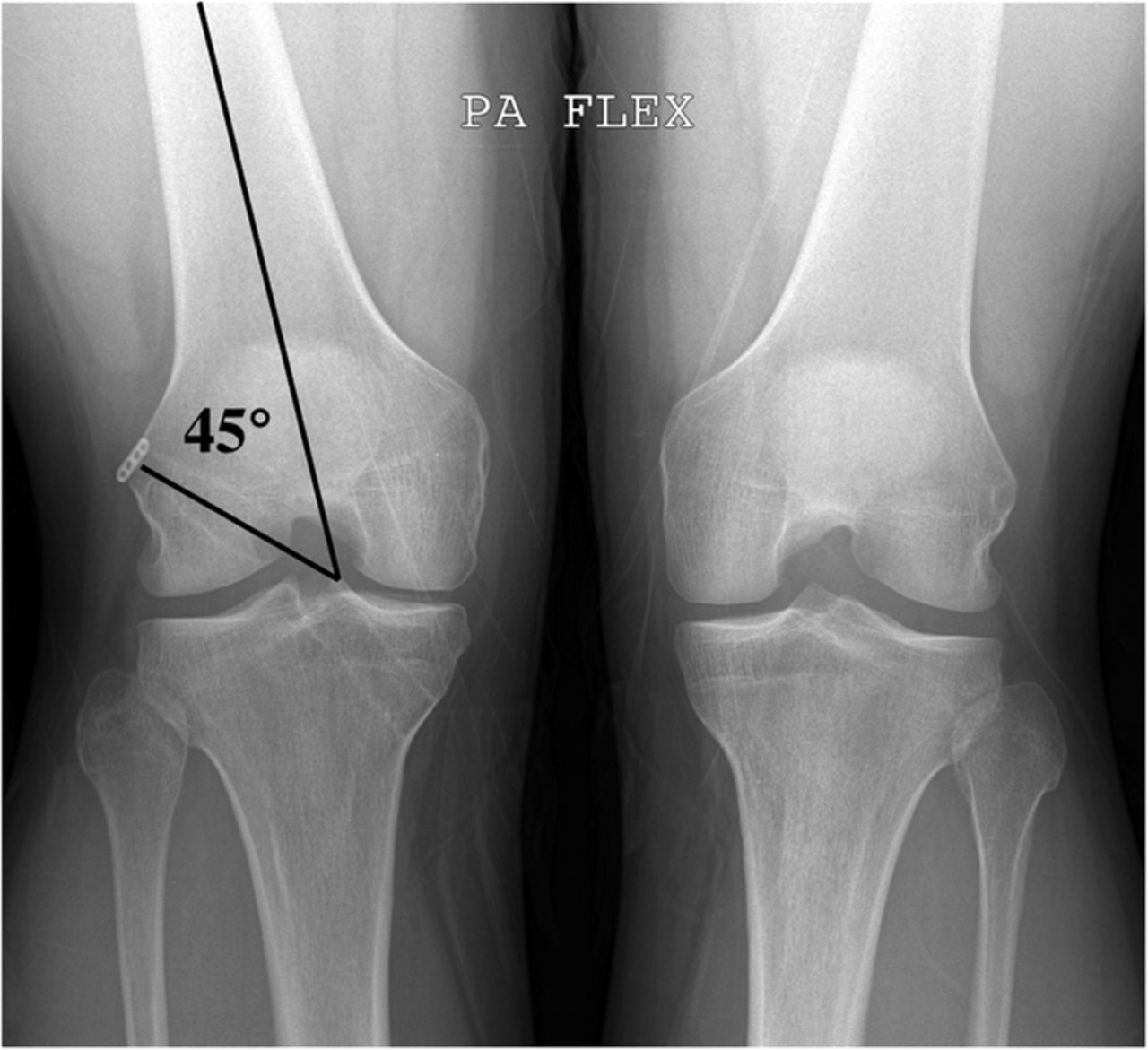 High Rates of Return to Play and Patient Satisfaction after ACL ...