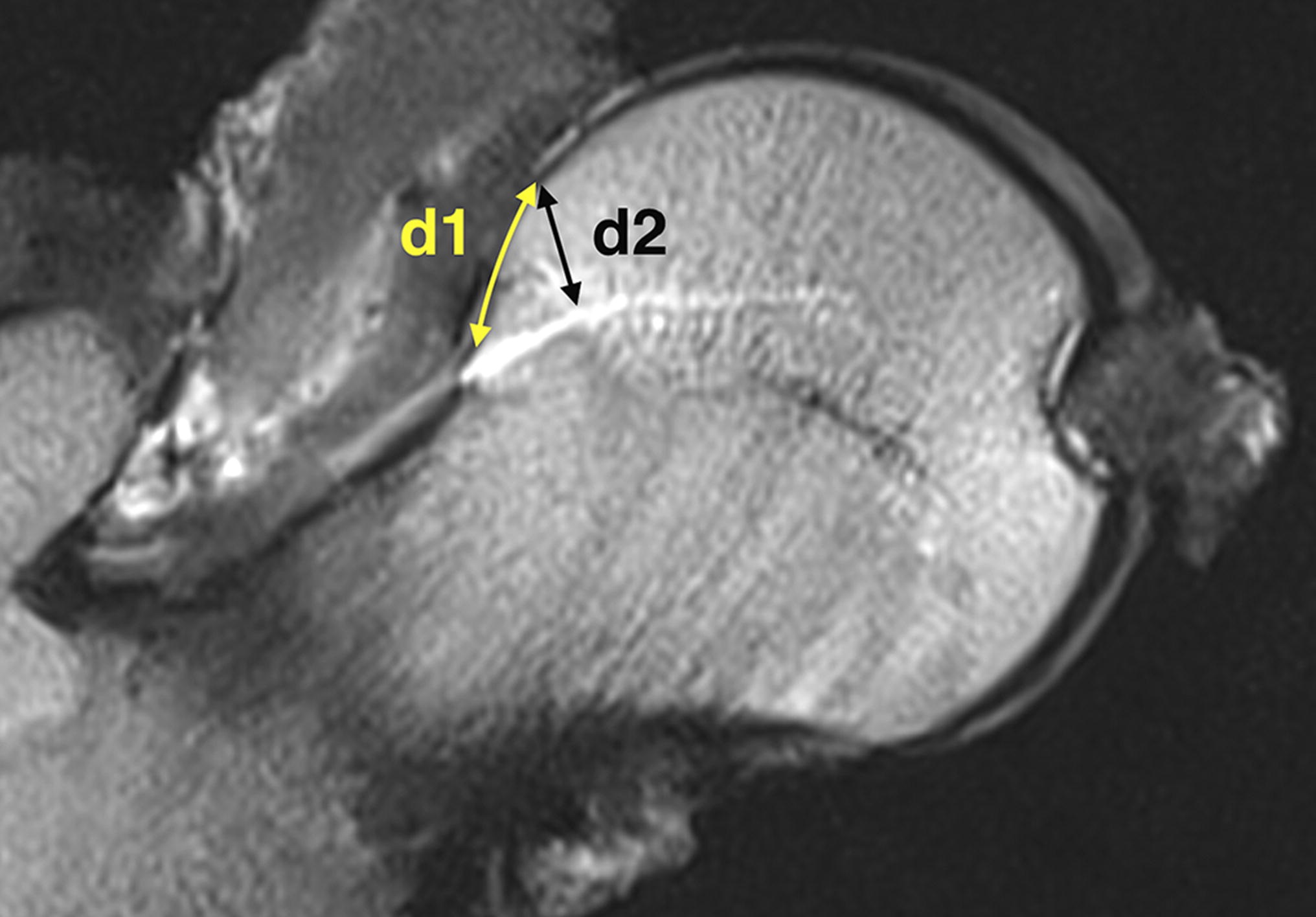 Where Does the Blood Flow in the Femoral Head? - OrthoBuzz