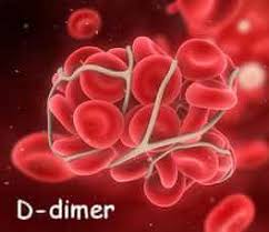 D-Dimer Levels May Help with PJI Diagnoses - OrthoBuzz
