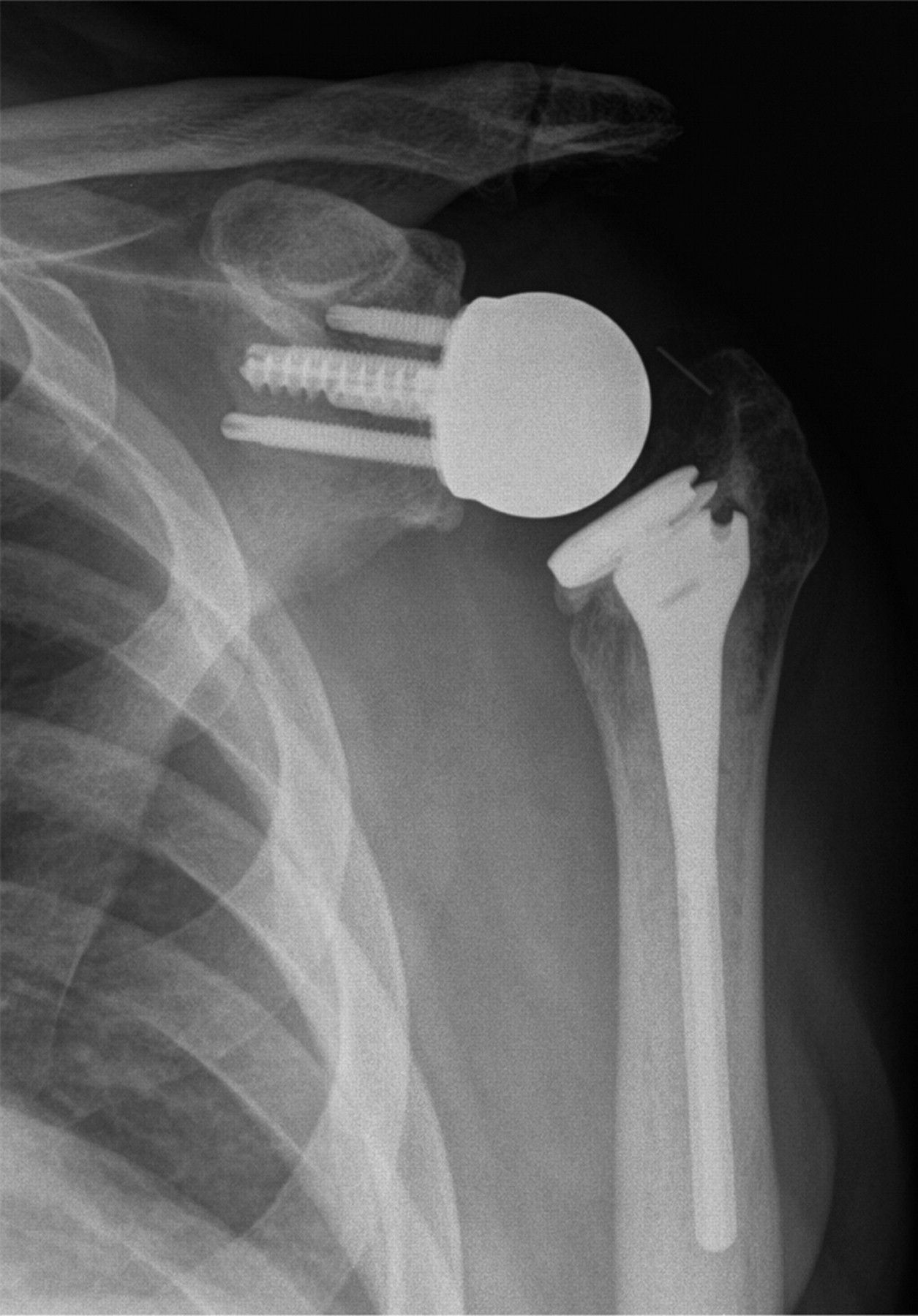 For Rotator Cuff Deficiency, RSA Delivers Good Long-term Results ...