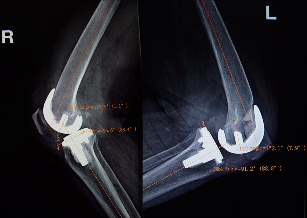 Less Postop Stiffness with Simultaneous Bilateral TKA - OrthoBuzz