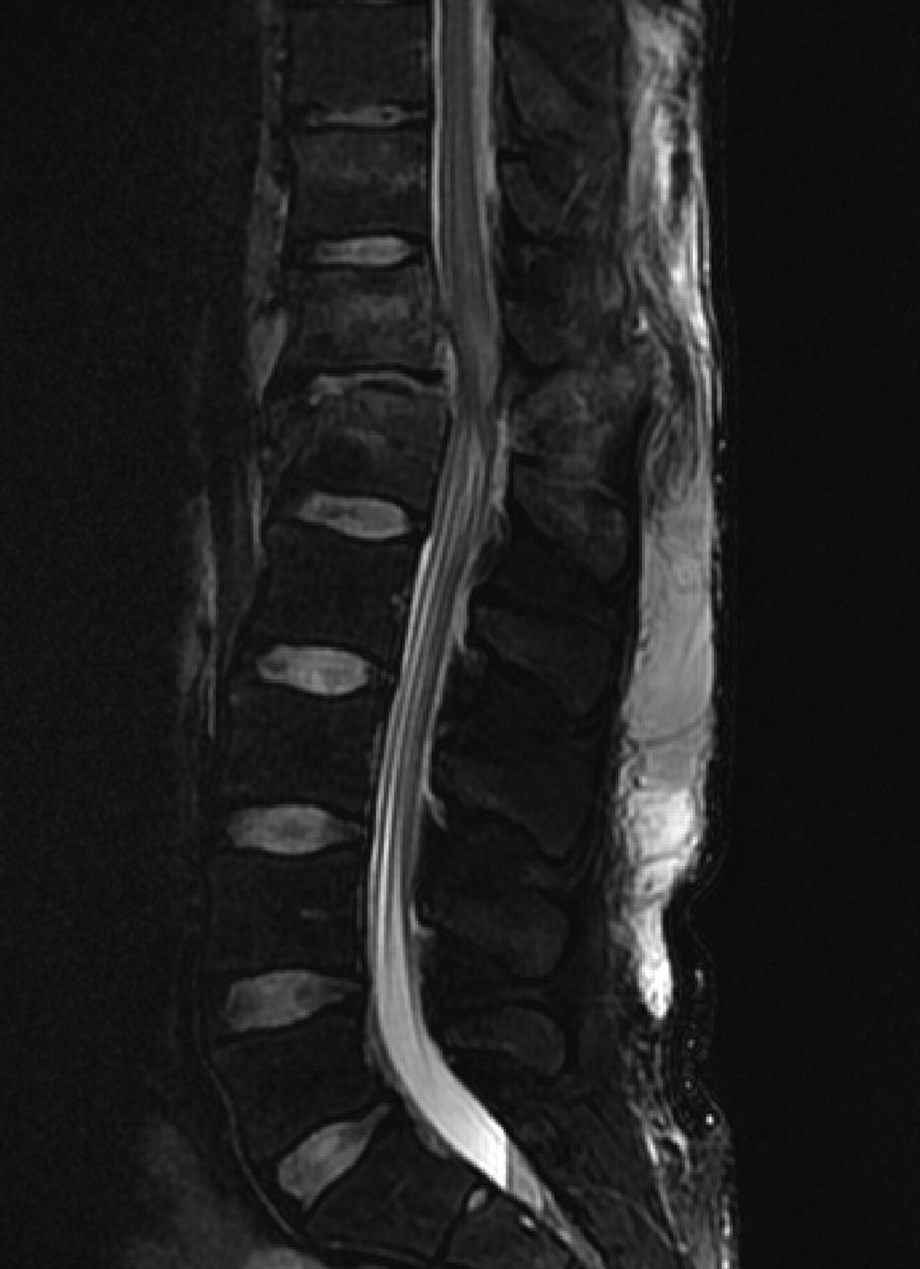 Cord Compression Reflects Neurological Outcomes after Thoracolumbar ...