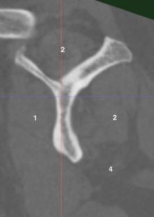 Which Pathology Comes First—Bone Loss or Fatty Infiltration of Rotator ...