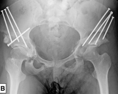 Periacetabular Osteotomy Yields Good Midterm Outcomes for Patients with ...
