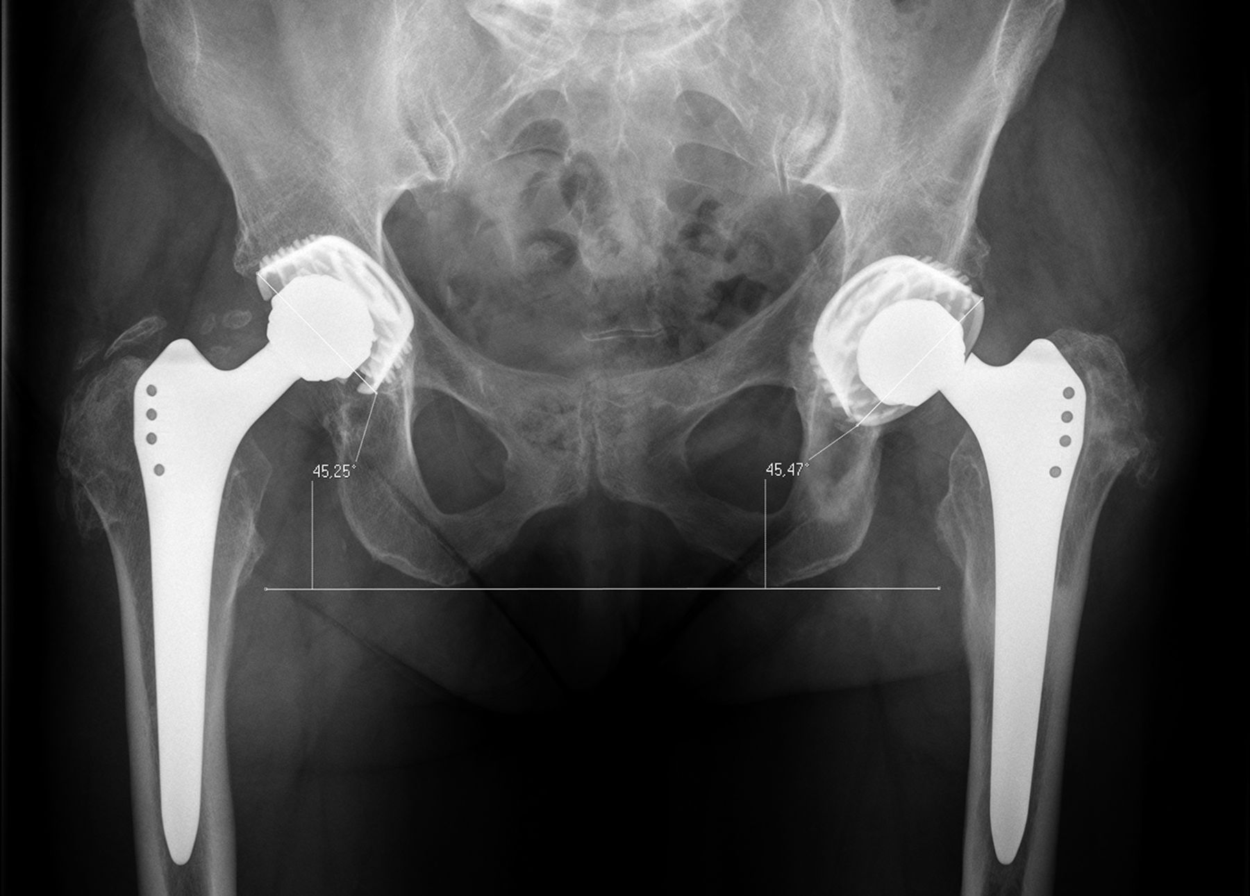 Will a Hip Replacement Help You Live Longer? - OrthoBuzz