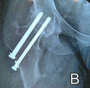 Predicting Failure of Femoral Neck Fixation - OrthoBuzz