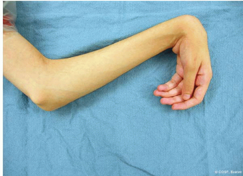 Properly Selected Patients with Cerebral Palsy Benefit from Upper ...