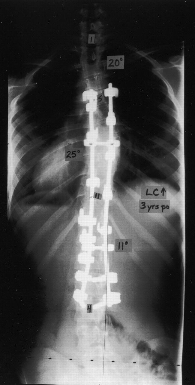 Confirmed: TXA Works Well in Adolescent Scoliosis Surgery - OrthoBuzz