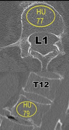 Using CT Data to Diagnose Osteoporosis - OrthoBuzz