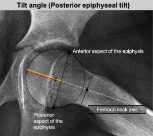 epiphyseal tilt Archives - OrthoBuzz