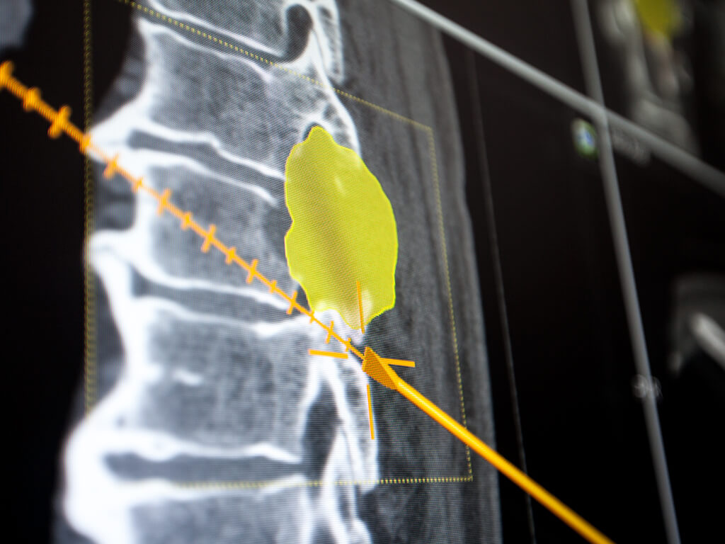 Spine/Trauma 3D Navigation Software Recall - OrthoBuzz