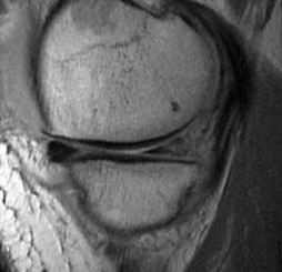 Meniscal Extrusions: Imaging and Repair - OrthoBuzz