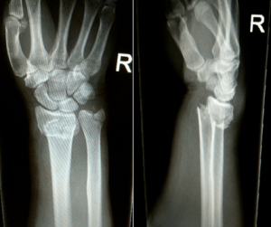 “Appropriate” Management of Distal Radial Fractures Improves Outcomes ...
