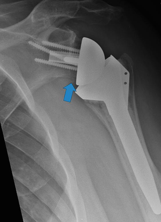 Volume-Outcome Relationships in Reverse TSA - OrthoBuzz
