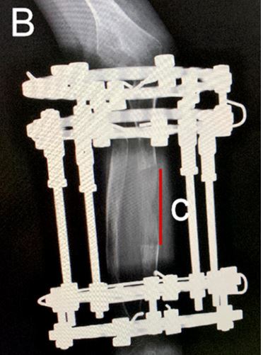 ulnar lengthening Archives - OrthoBuzz