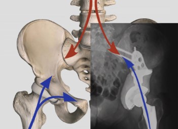 3D-Printed Endoprosthesis Yields Promising Early Results - OrthoBuzz