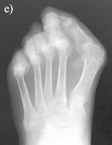 Outcomes of Joint-Preserving Surgery in RA-Affected Feet - OrthoBuzz