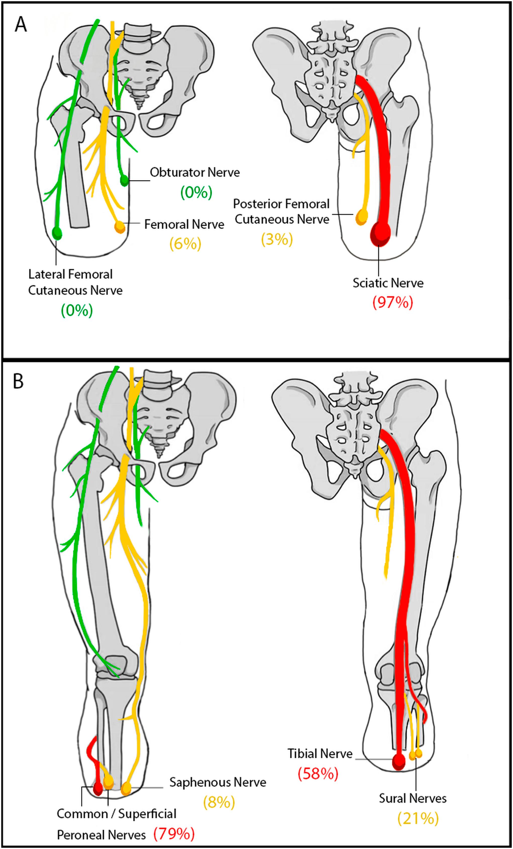 Targeted Muscle Reinnervation Helps Reduce—and Prevent—Pain in Amputees ...