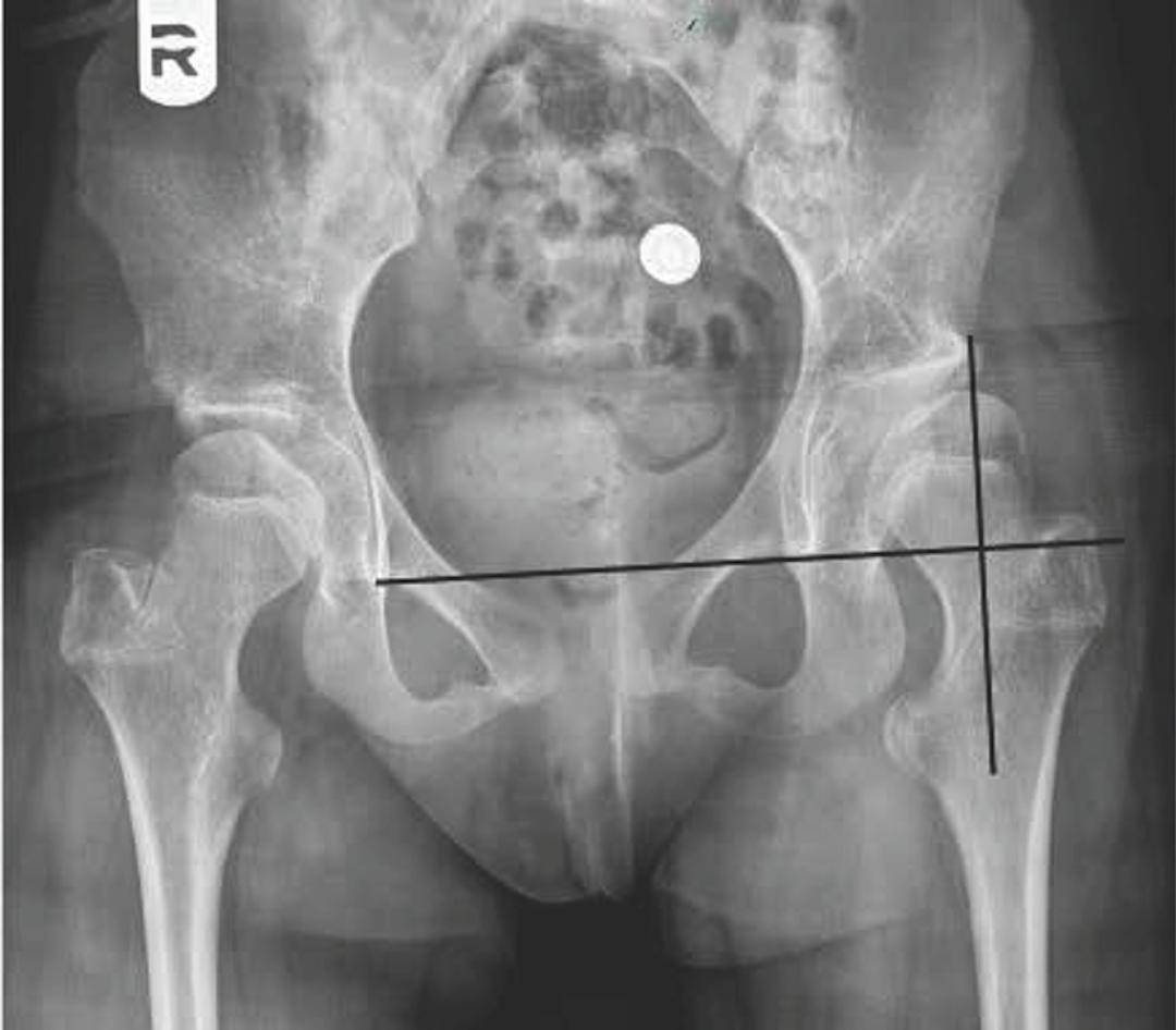 Identifying Risk of Progressive Hip Displacement After Skeletal ...