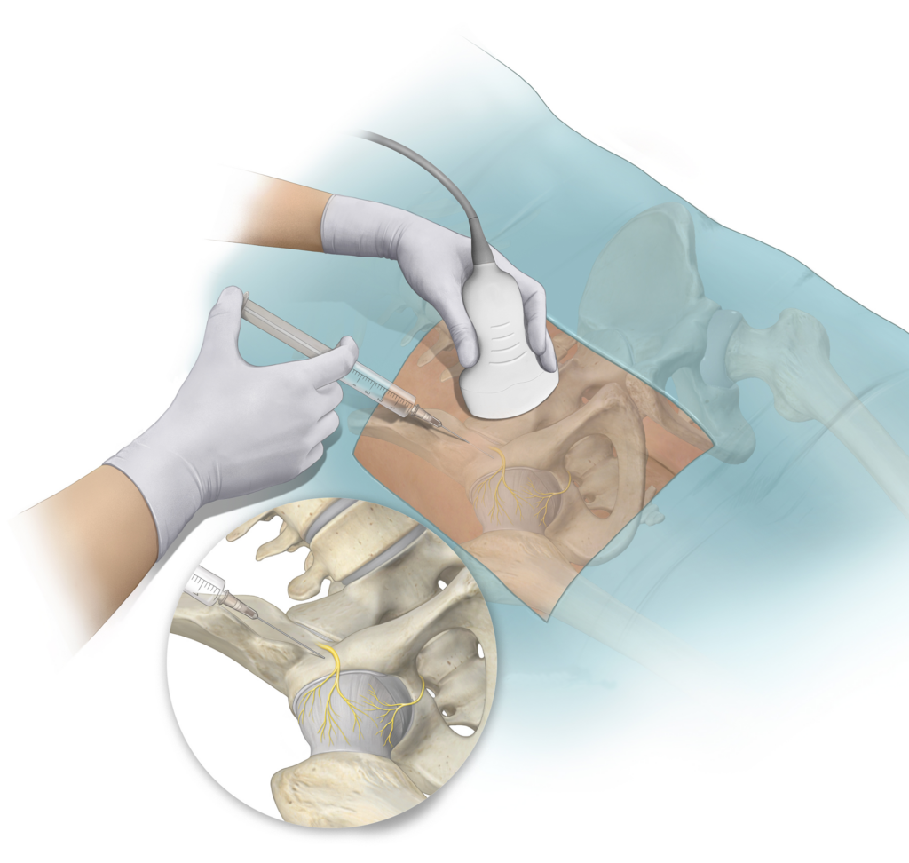 Regional Blocks in Arthroplasty: 2 Double-Blinded RCTs in the New Issue ...