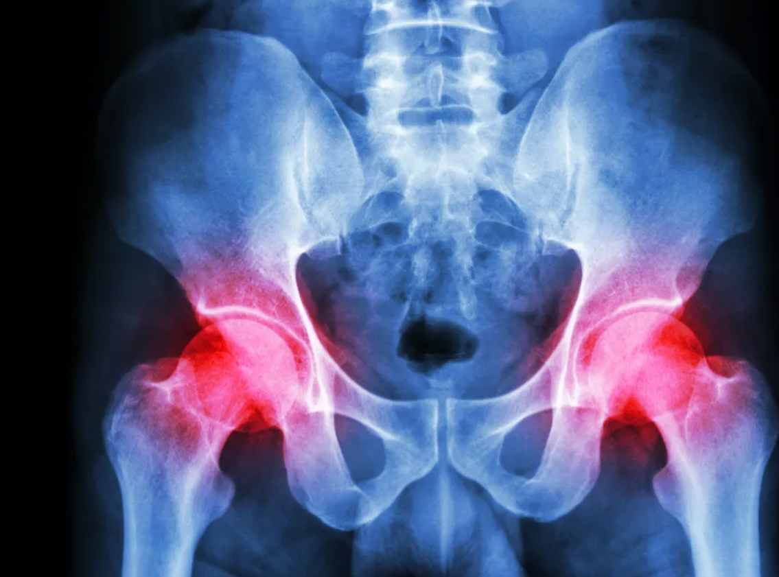 What’s New in Hip Surgery 2025 - OrthoBuzz